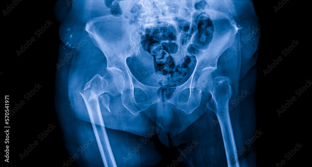 Radiograph on dark background in hospital.The xray is used for ...