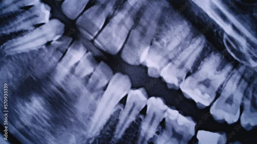 X-ray image of the jaw of all human teeth close-up. Magnetic resonance ...