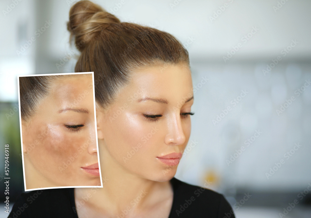 Dark spots, freckles,hyperpigmentation(melasma or chloasma),concept ...