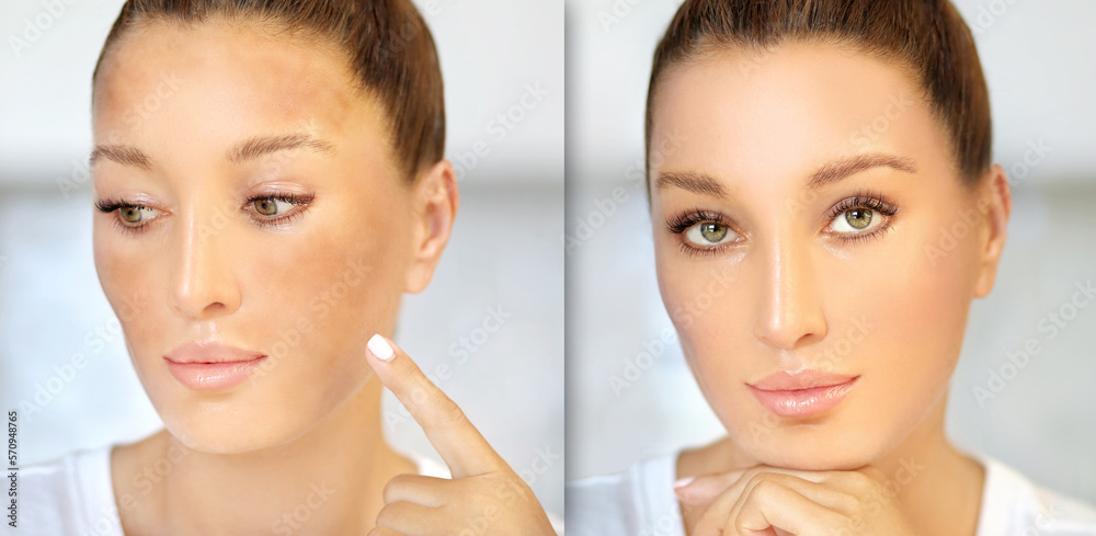 Dark spots, freckles,hyperpigmentation(melasma or chloasma),concept ...
