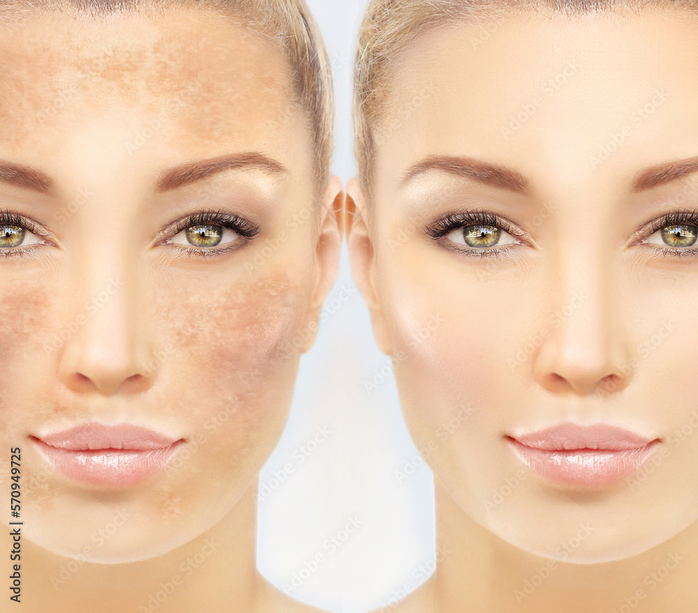 Dark spots, freckles,hyperpigmentation(melasma or chloasma),concept ...