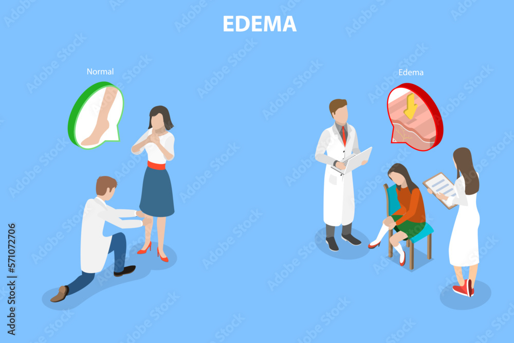 3D Isometric Flat Vector Conceptual Illustration of Edema, Legs ...