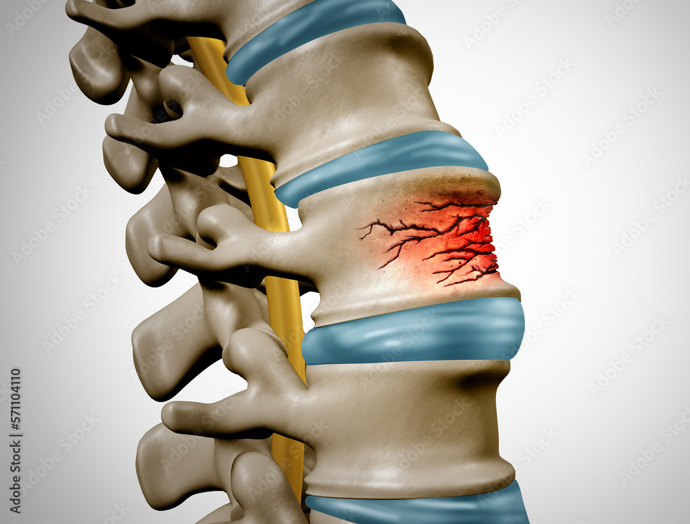 Traumatic Spine Fracture and vertebral injury medical concept as a ...