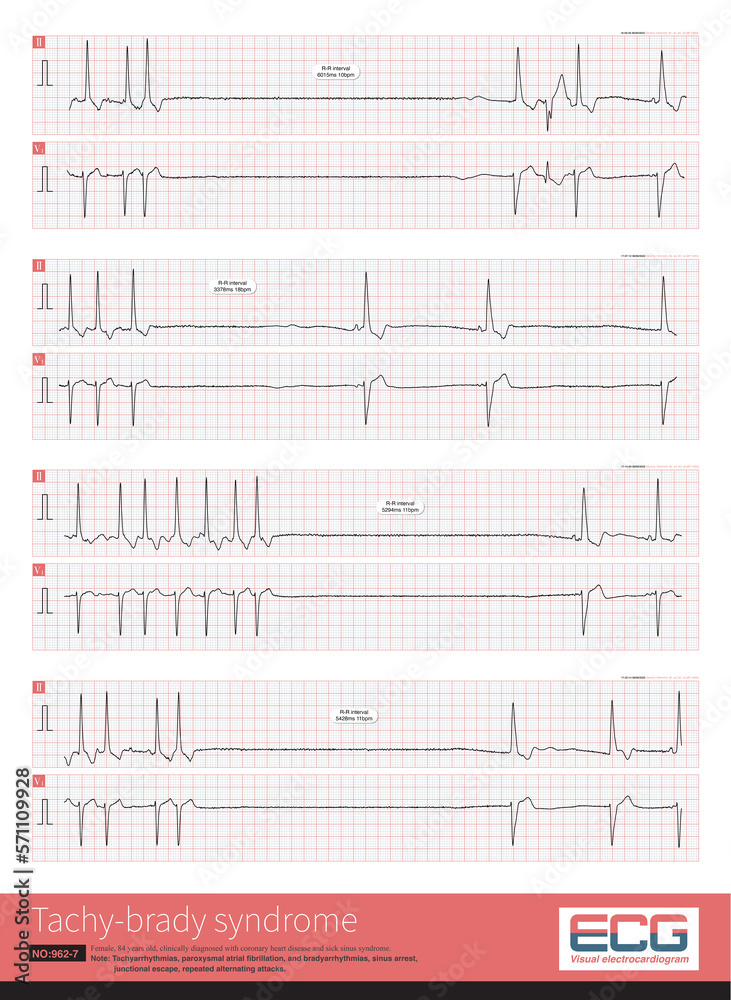 After the paroxysmal atrial fibrillation attack stopped, there was a long period of sinus arrest ...