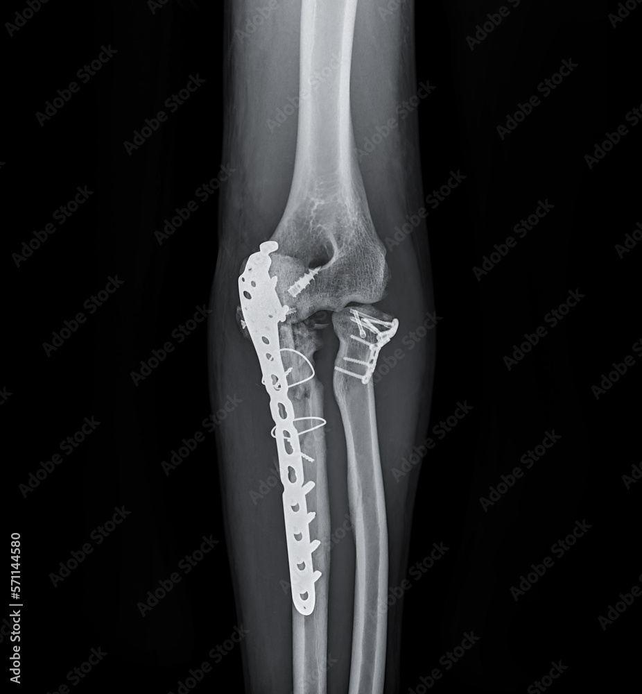 Foto de X-ray of Elbow showing internal fixation of the elbow joint. do ...