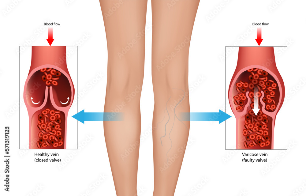 Vetor de Venous Disease or Varicose vein and Faulty valve. Chronic ...