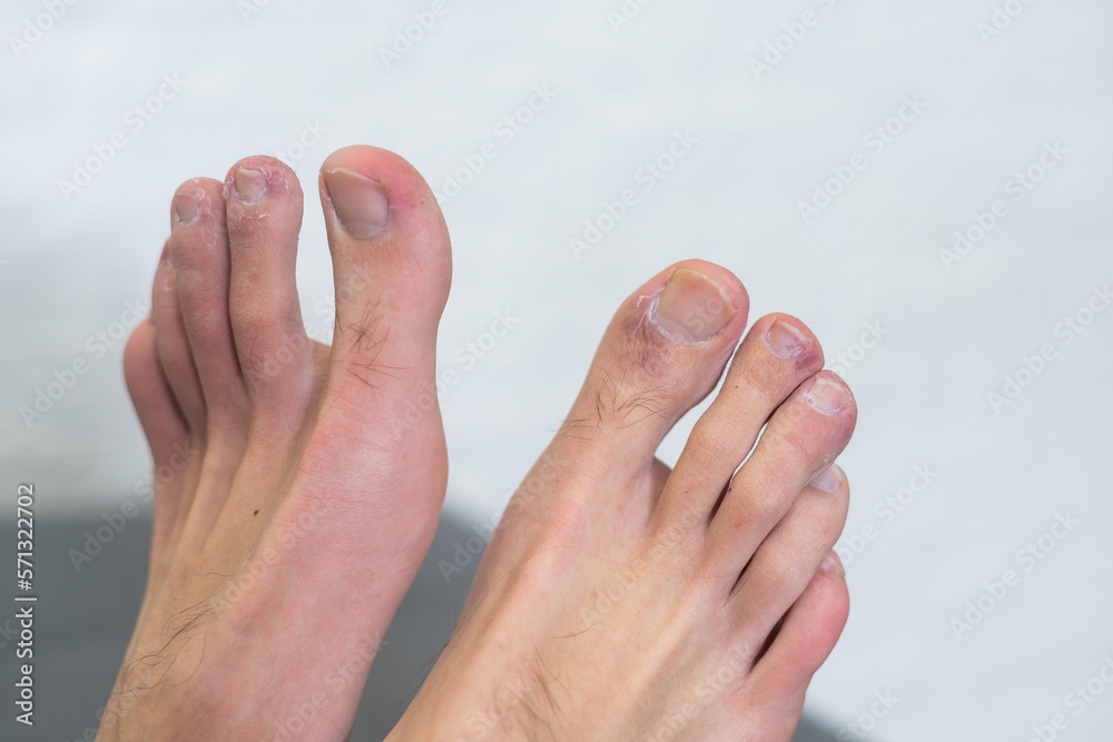 A white man holding his toes, showing what looks like a rash with red ...