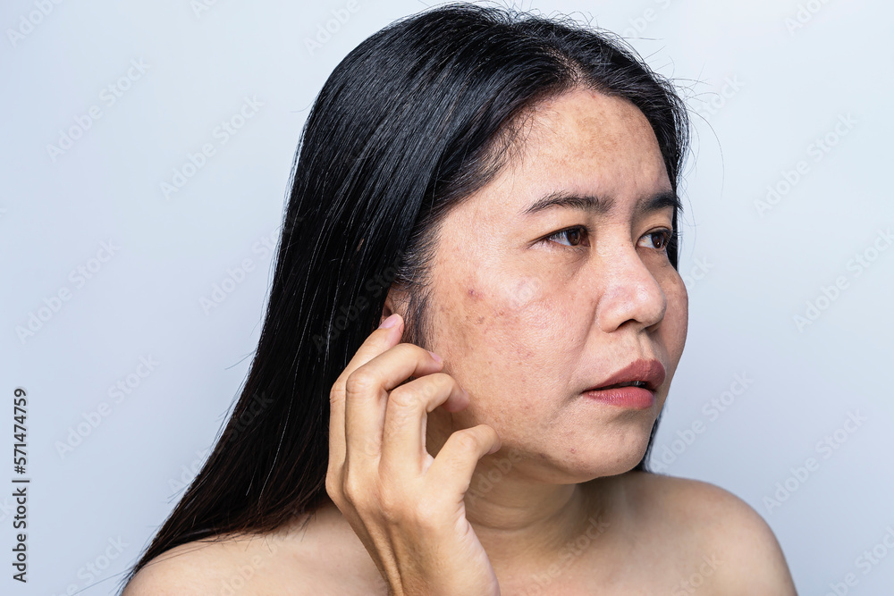 Asian adult woman face has freckles, large pores, blackhead pimple and ...