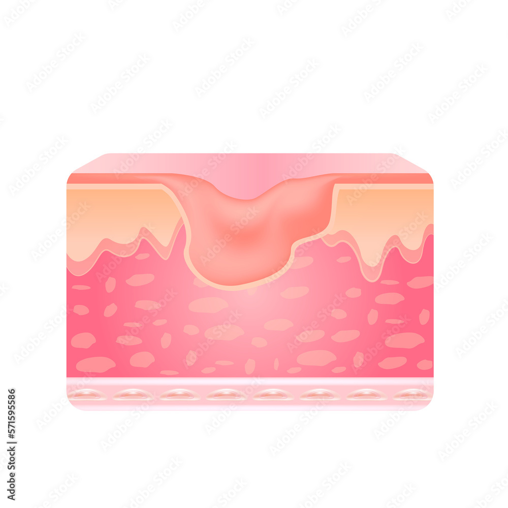 Acne scar vascular. Inflammation associated with pimples. The structure ...