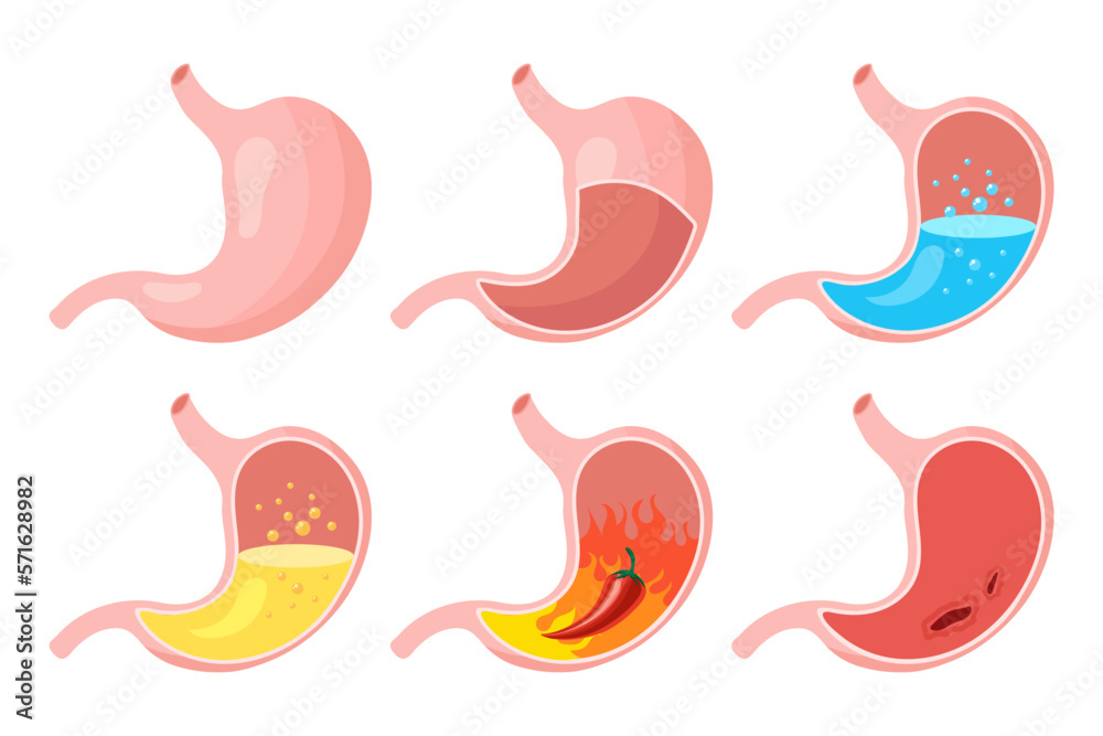 Healthy and unhealthy, empty and full human stomach in flat style ...