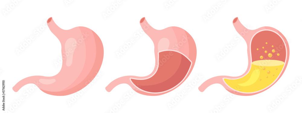 Healthy and unhealthy, empty and full human stomach in flat style ...