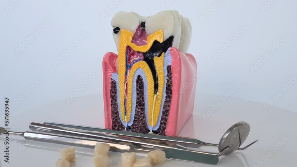 Dentistry anatomy of tooth extraction with caries. Health problems and ...