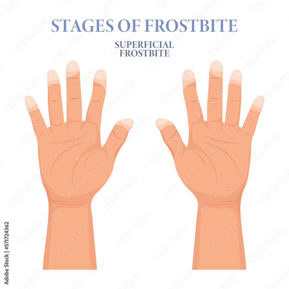 Frozen hands in different stages. Medical frostbite. Stages of ...