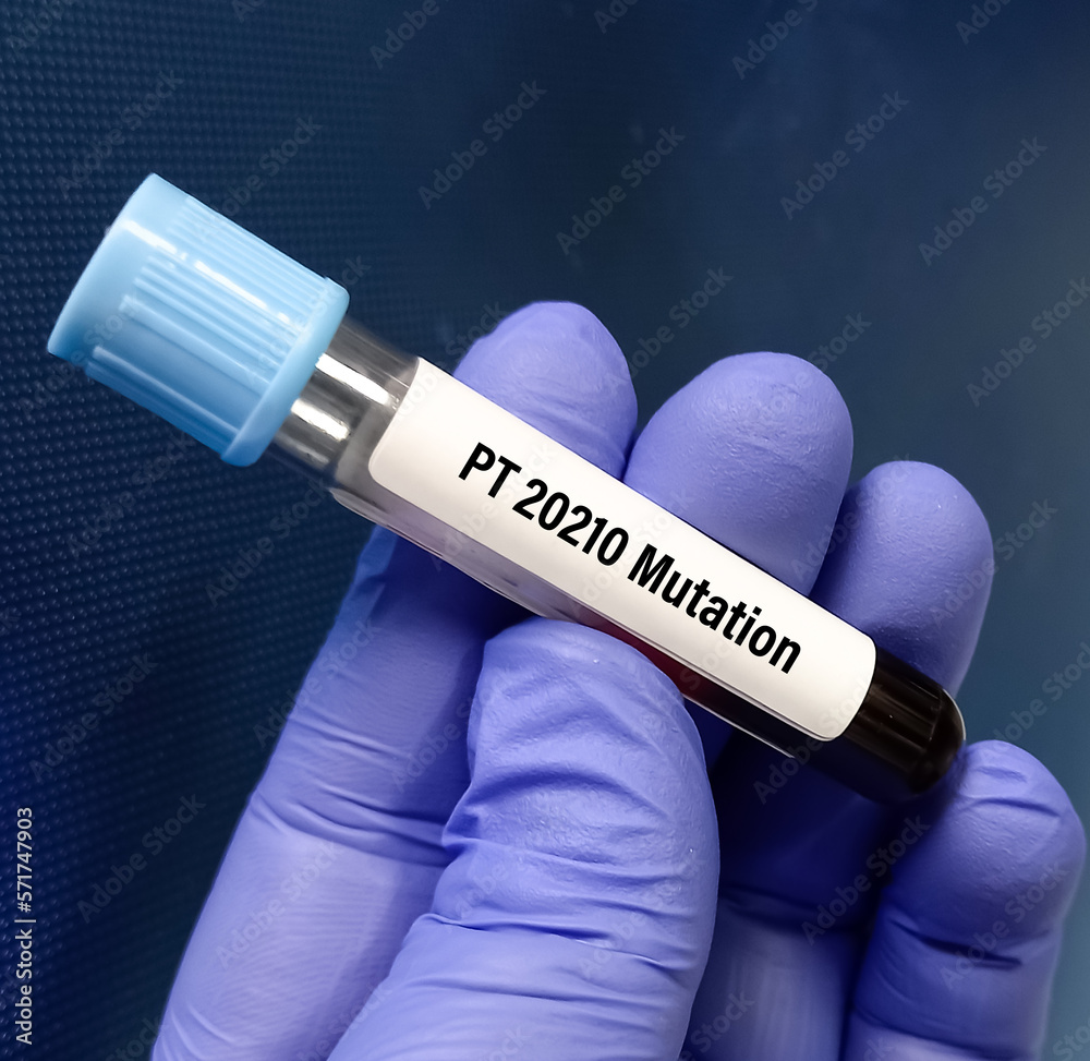 Blood sample for Prothrombin G20210A mutation test, a mutation of ...