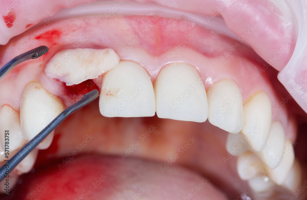 Foto de Soft tissue augmentation procedures. Gum grafting from the ...
