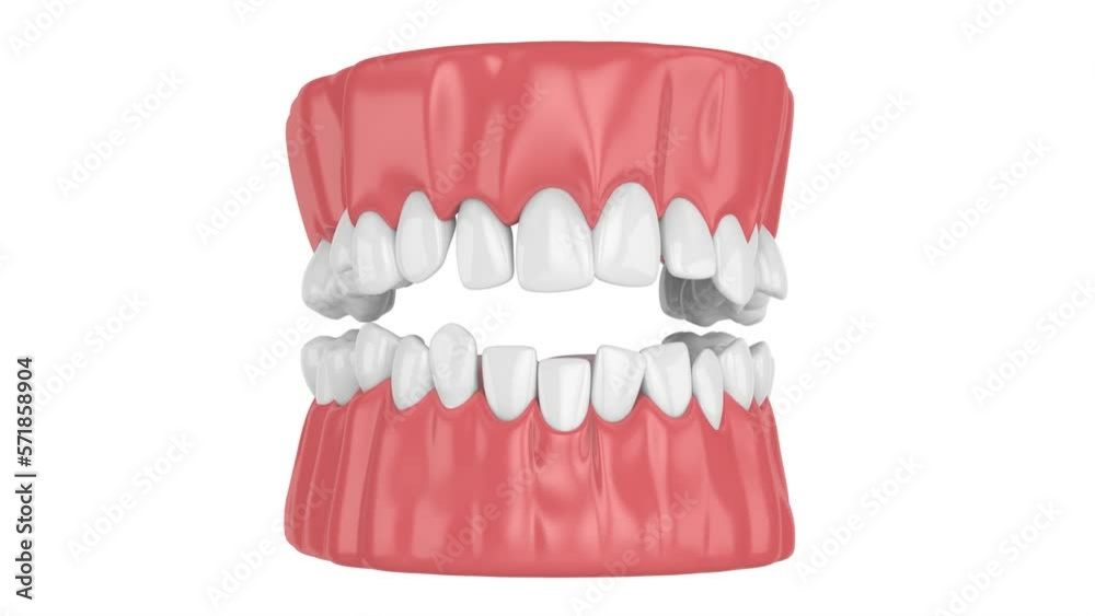 Human jaw with crooked teeth straightening. Orthodontic treatment ...