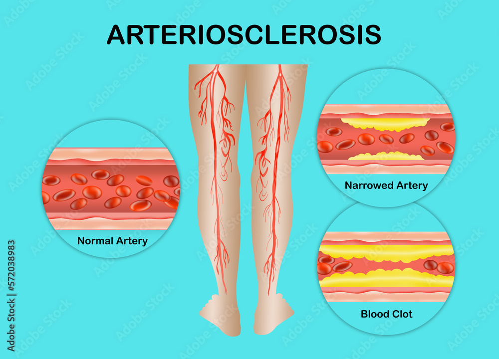 Human legs. Artery with blood cells desease. Concept of dry skin, old ...