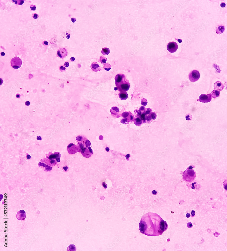 Ascetic fluid cytology, Malignant cells, Metastatic adenocarcinoma ...