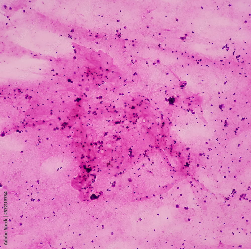 Ascetic fluid cytology, Malignant cells, Metastatic adenocarcinoma ...