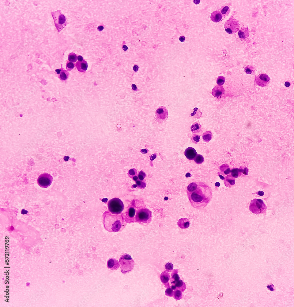 Ascetic fluid cytology, Malignant cells, Metastatic adenocarcinoma ...