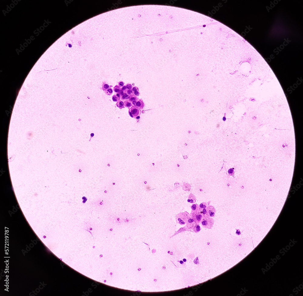 Ascetic fluid cytology, Malignant cells, Metastatic adenocarcinoma ...