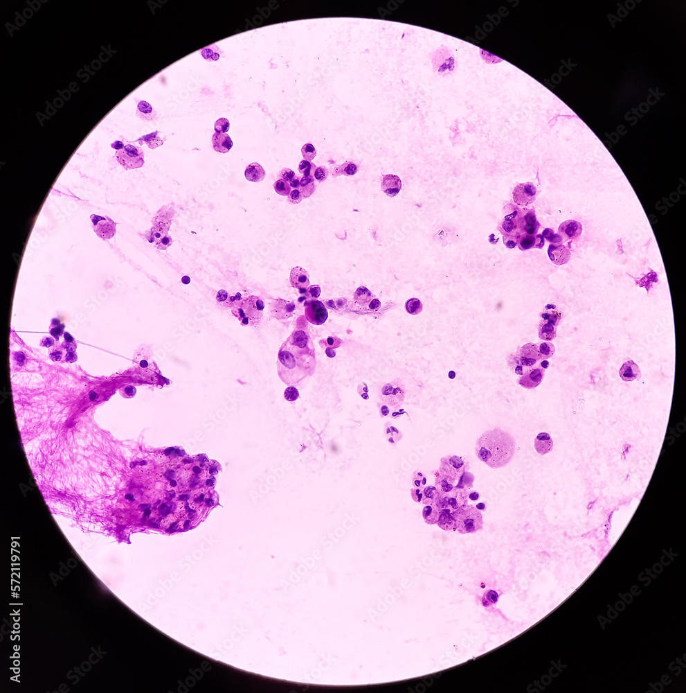 Ascetic fluid cytology, Malignant cells, Metastatic adenocarcinoma ...
