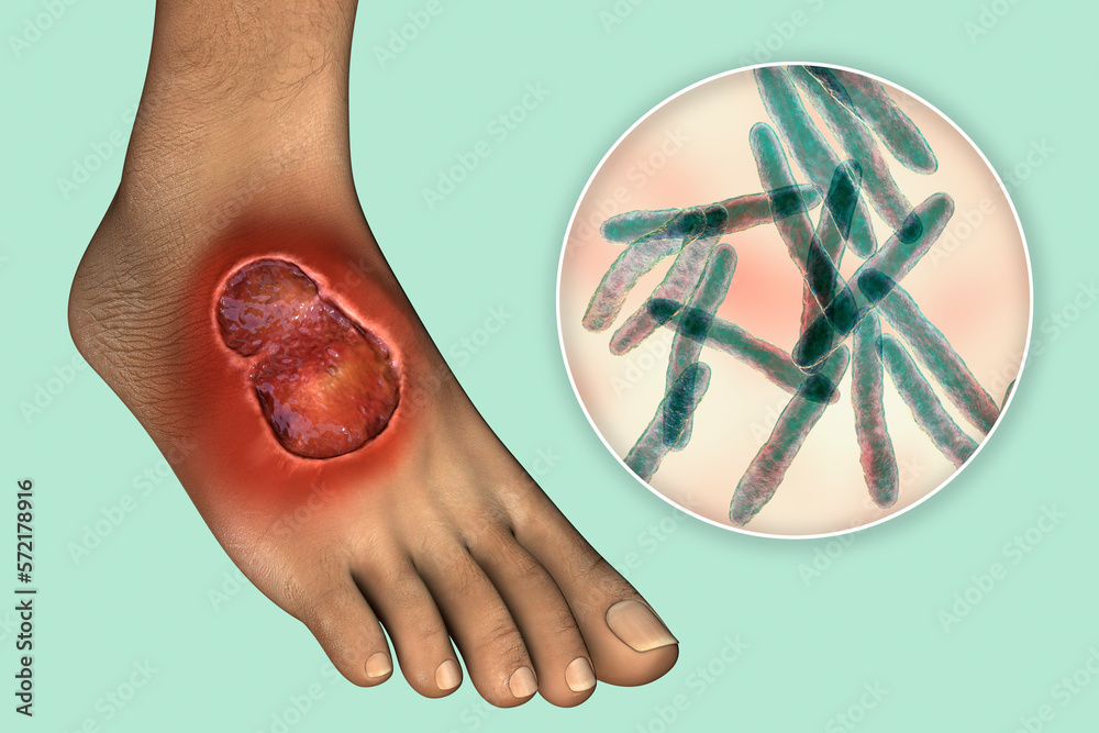 Buruli ulcer on a patient foot, 3D illustration. The disease caused by ...