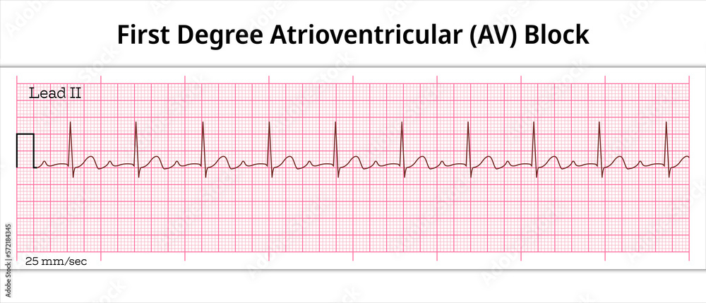 ECG First Degree Atrioventricular Block - 1st degree AV Block - 8 ...
