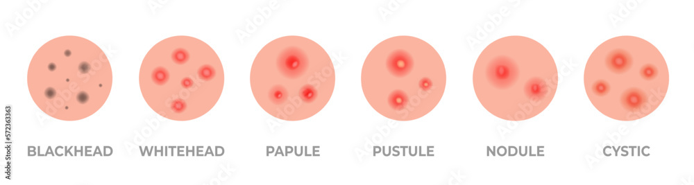 Acne types set. Skin pimples, blackheads and face comedones. Acne skin ...