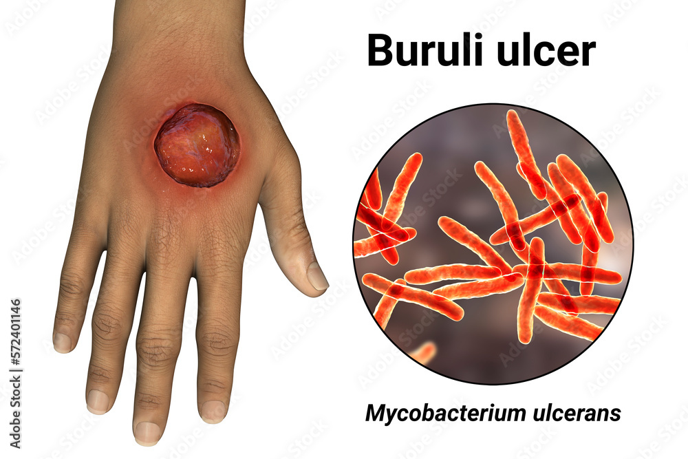 Buruli ulcer on an arm, 3D illustration. The disease caused by ...