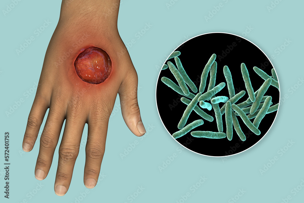 Buruli ulcer on an arm, 3D illustration. The disease caused by ...