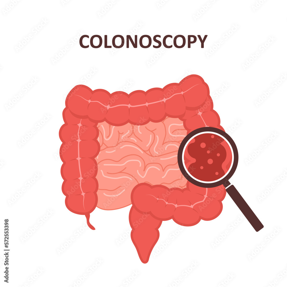 Colonoscopy concept. Intestine exam and treatment. Colon polypectomy ...