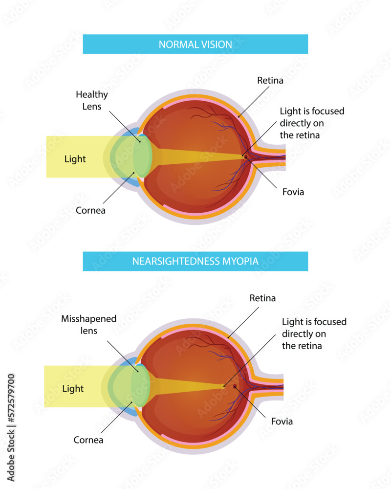 Poster Myopia disease vector infographic, design illustration for ...