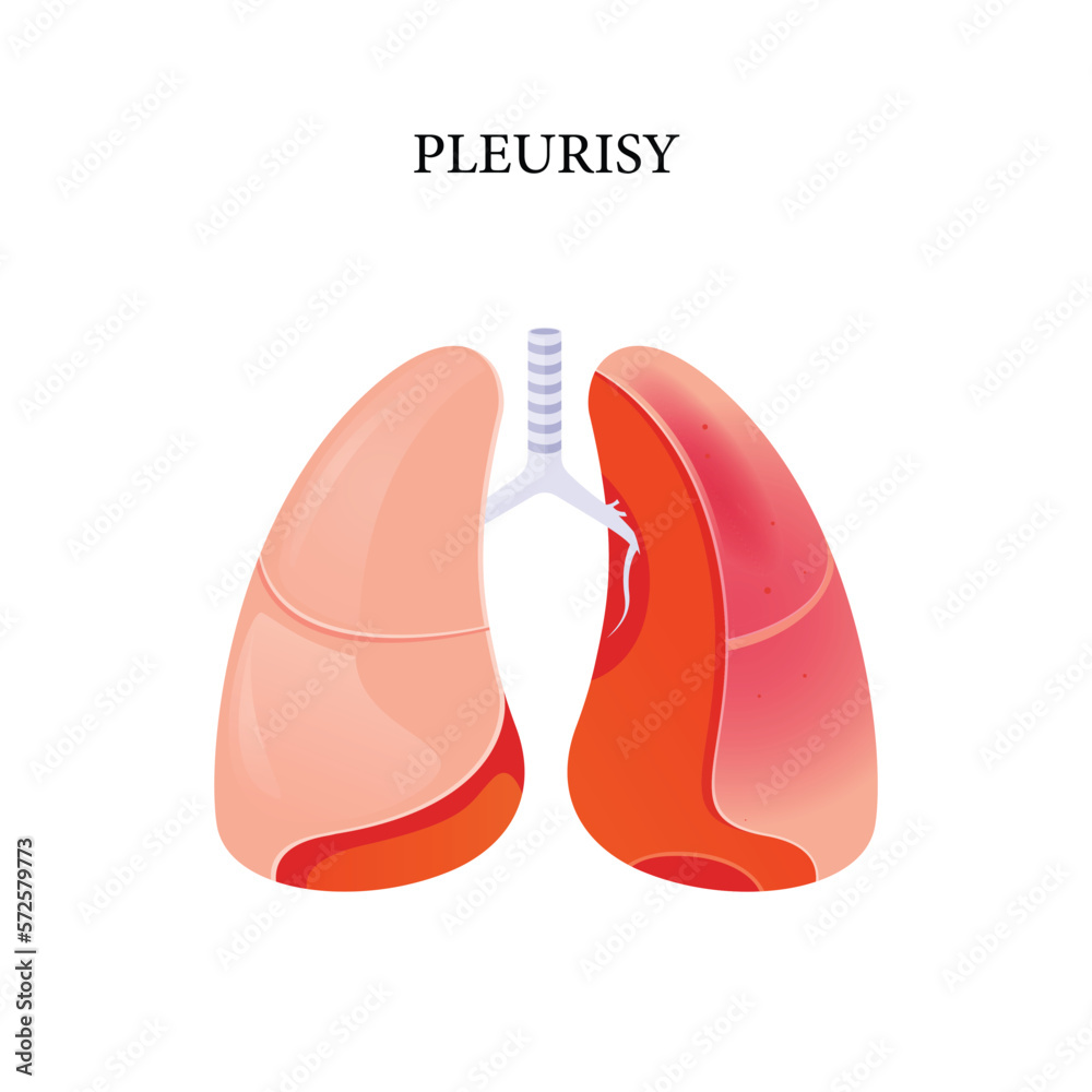 Pleurisy vector, illustration of pleurisy disease, vector design for ...