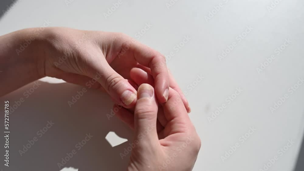 Hands with nail disease - onycholysis, on a white background ...