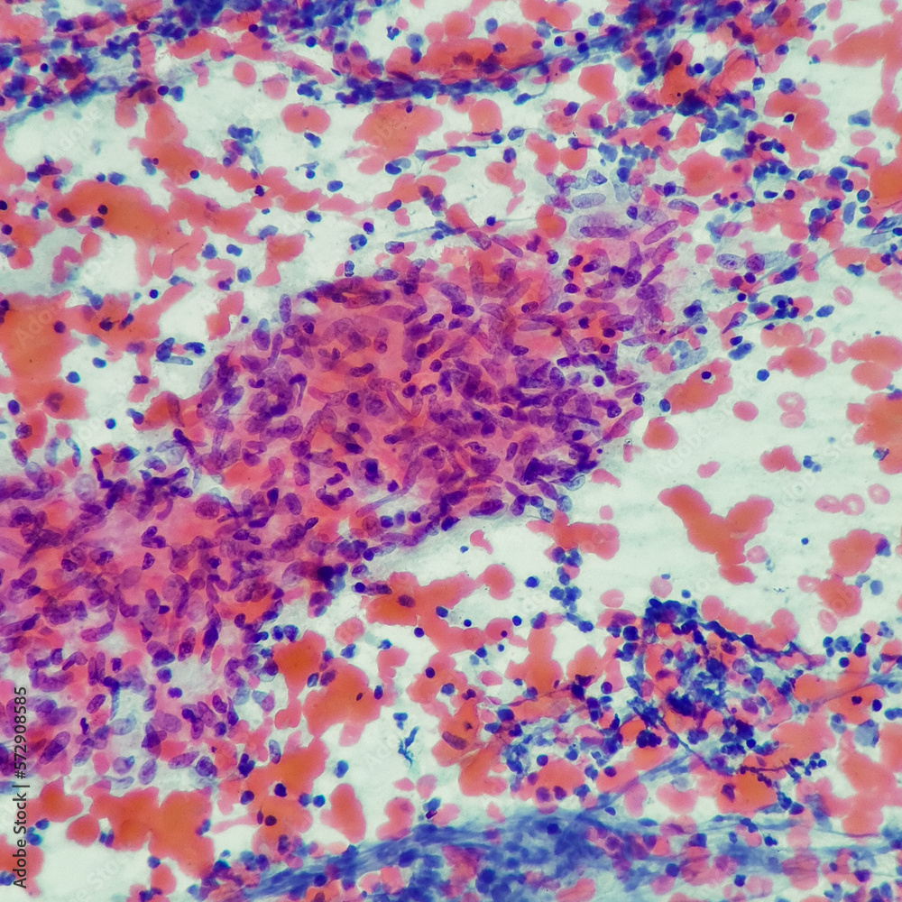 Camera photo of granuloma in cytological specimen from cervical lymph ...