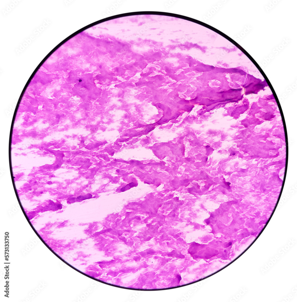 Scalp swelling cytology: Epidermal inclusion cyst. commonly called ...