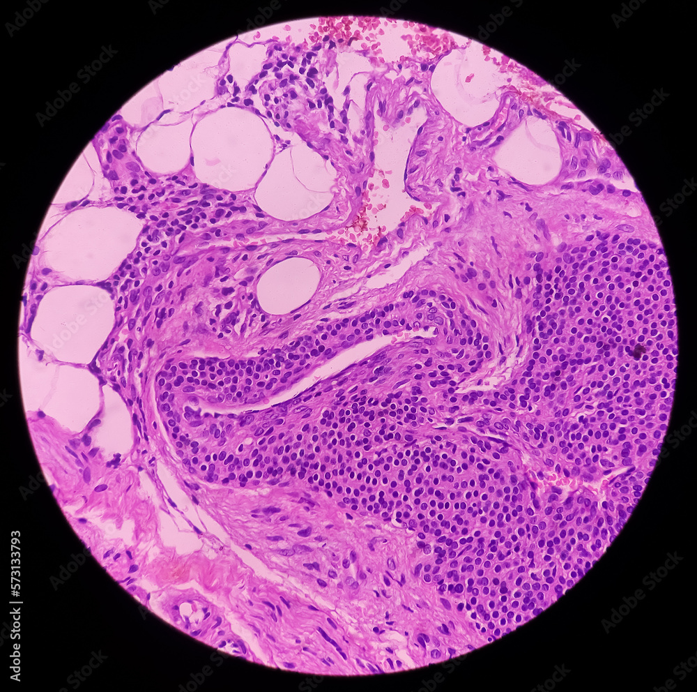 Cutaneous nodule (biopsy). Photomicrograph of glomangioma of skin ...