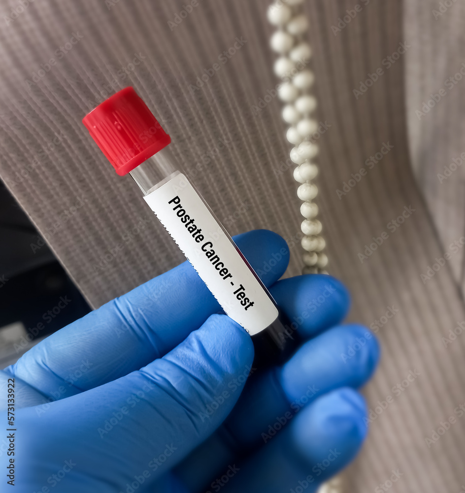 Blood sample tube for Prostate cancer test. Cancer screening tests. PSA ...