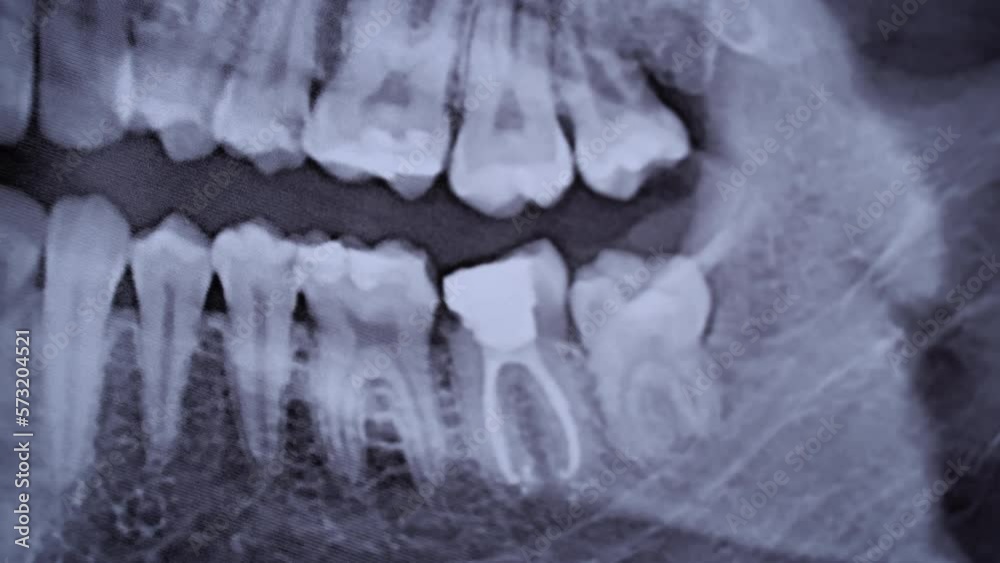 X-ray image of the jaw of all human teeth close-up. Magnetic resonance ...