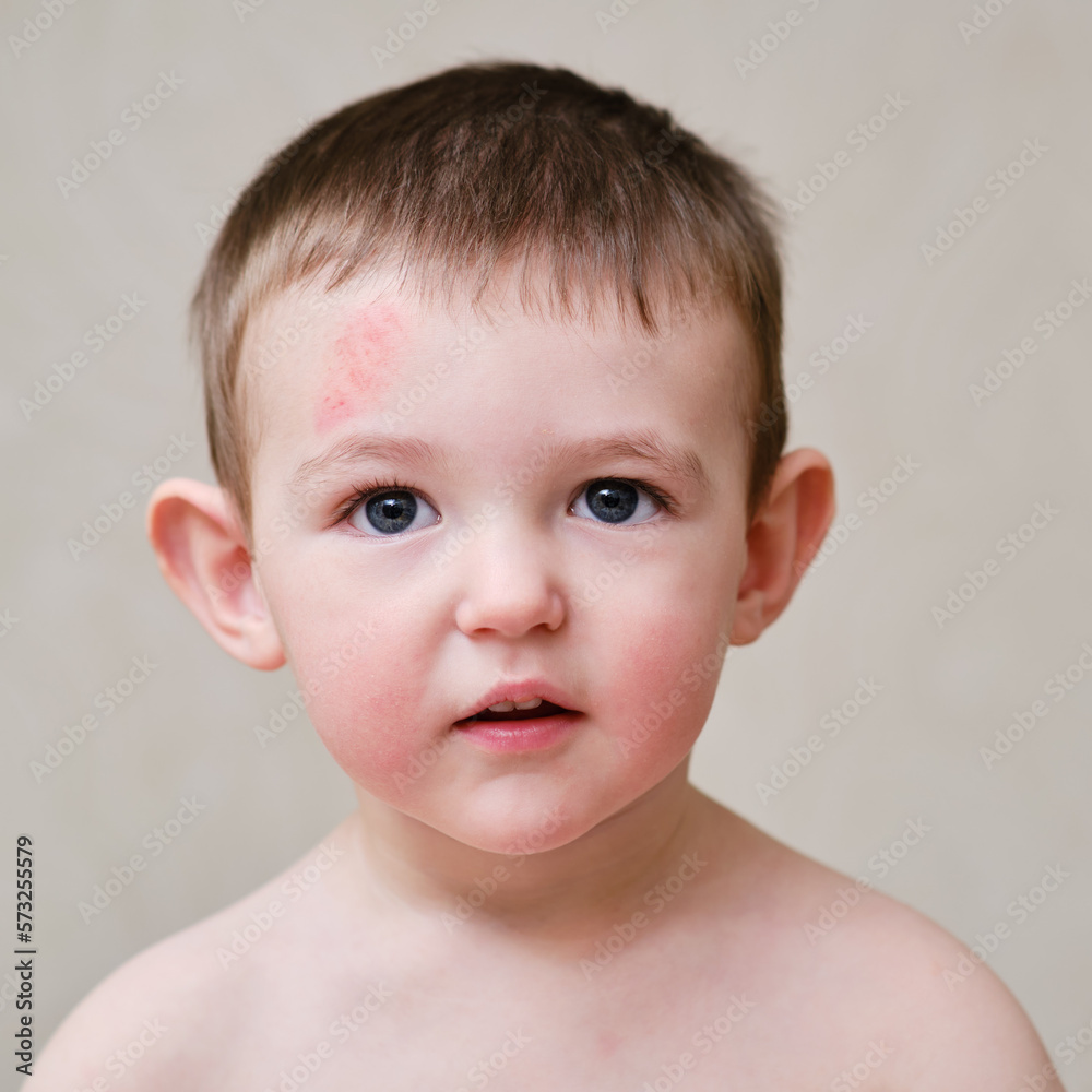 Toddler baby face with scratch on forehead. Portrait of a baby boy with ...
