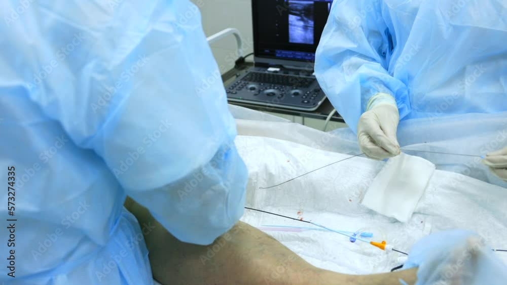 Introduction through small puncture radiofrequency catheter with ...