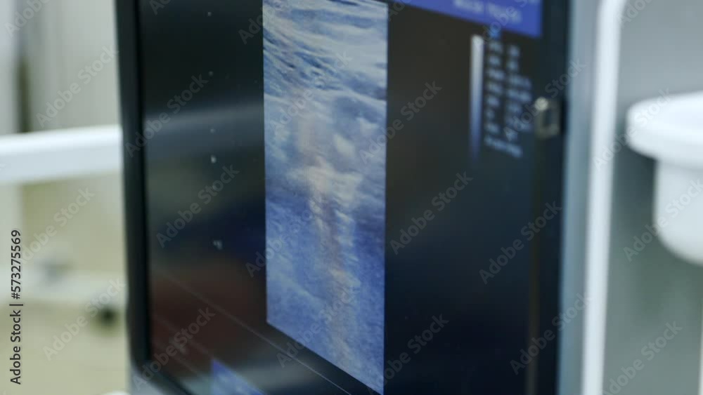 Black and white picture on the monitor of a modern ultrasound machine ...