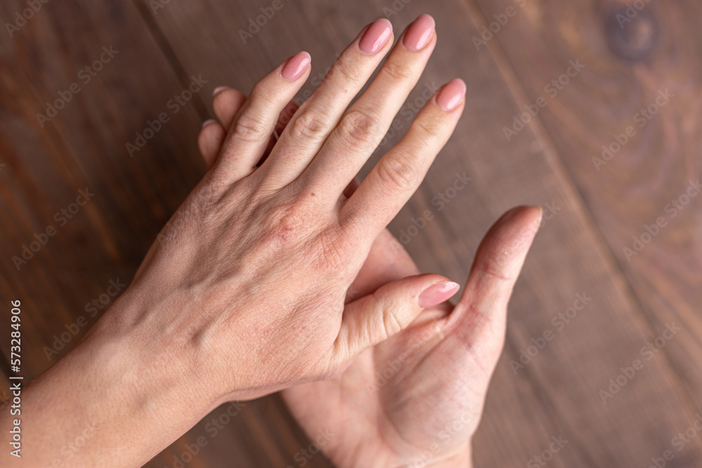 Extremely dry, dehydrated and cracked skin of a woman's hand. Allergy ...