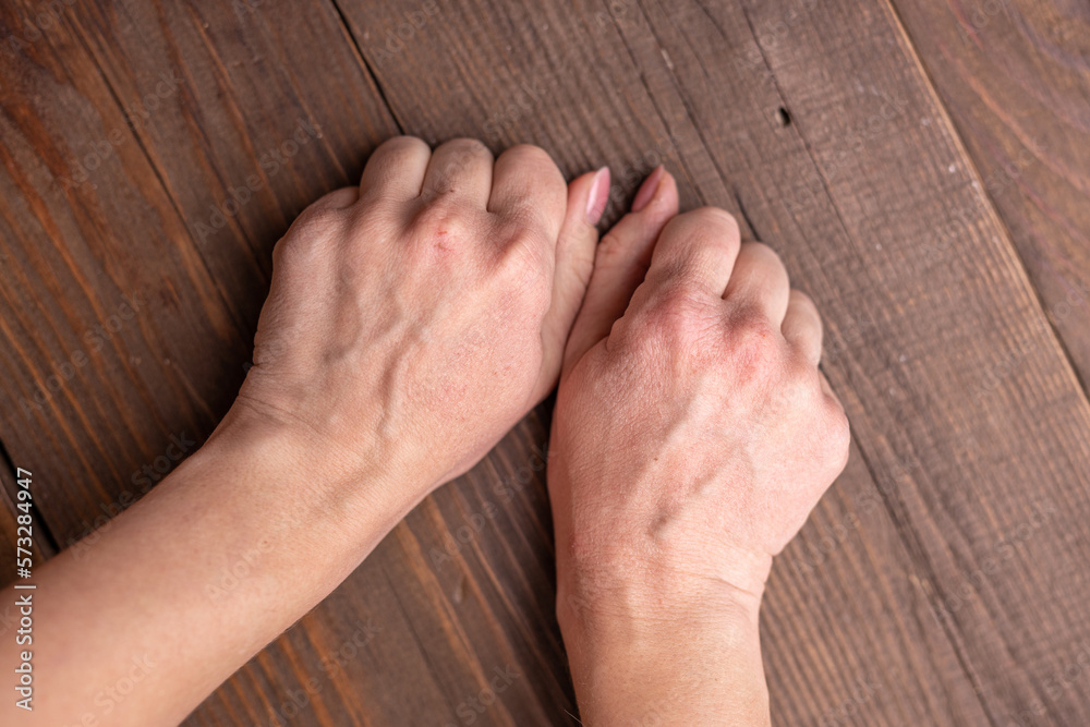 Extremely dry, dehydrated and cracked skin of a woman's hand. Allergy ...