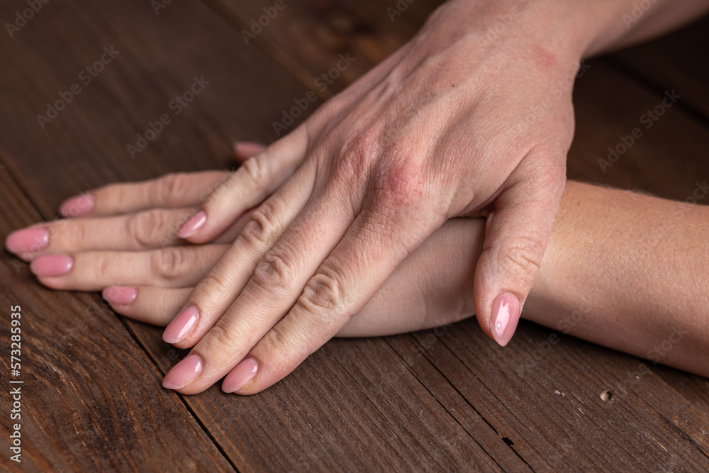 Extremely dry, dehydrated and cracked skin of a woman's hand. Allergy ...