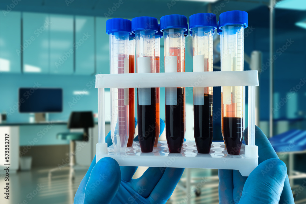 Test tubes with blood in hands. Plastic flasks with patient tests ...