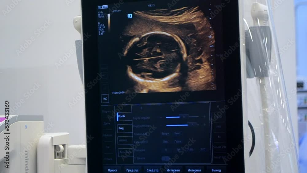 Video Stock Utrasound image on the monitor close-up. Ultrasound Scan ...
