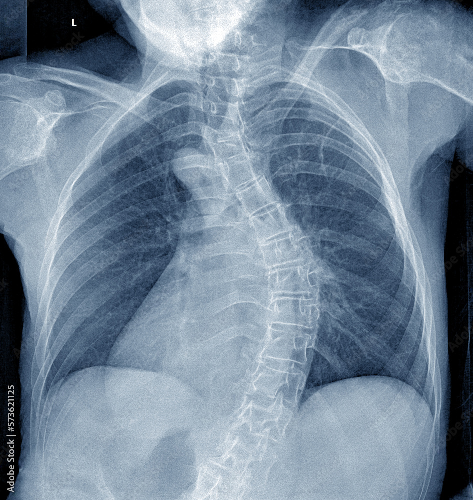 X-ray of the human chest organs, C-shaped scoliotic deformity of the ...