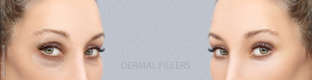 Tear Trough Filler,A-frame deformity. Fat grafting or dermal filler ...